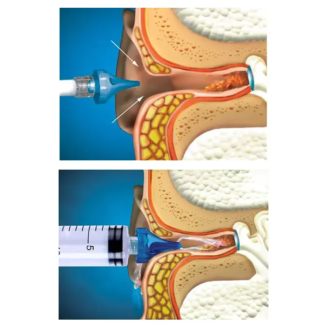 Acu-Life Ear Wax Removal Syringe - Medfirst Homecare